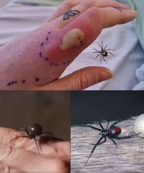 What to do if you get bit.ten by a black widow spider: A complete guide ...